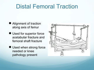 Bucks Traction For Femur Fracture