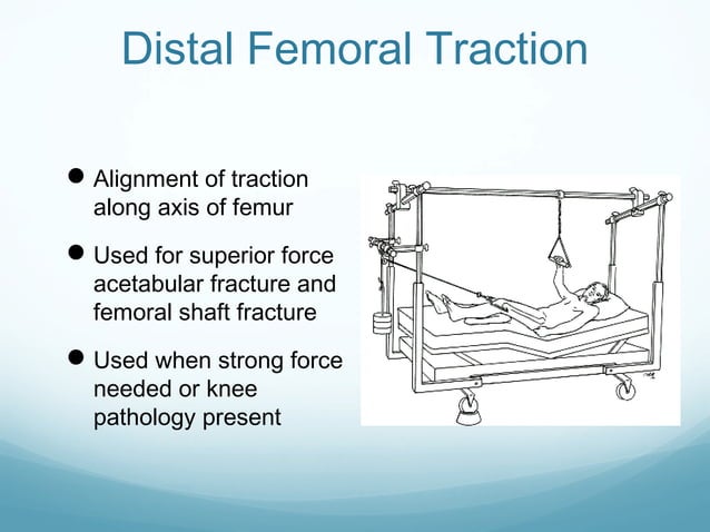 Application of traction in orthopaedics