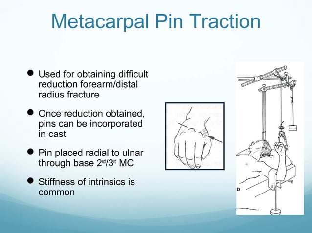 Application of traction in orthopaedics
