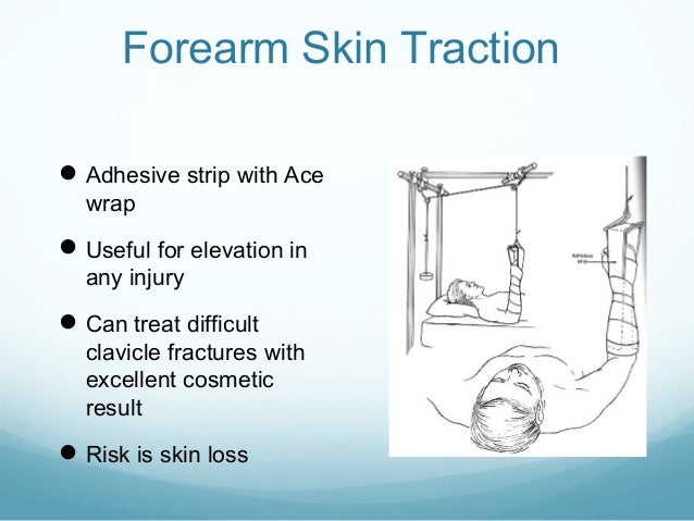 Application of traction in orthopaedics