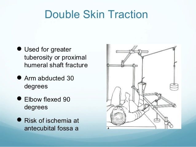 Application of traction in orthopaedics