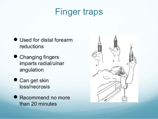 Application of traction in orthopaedics