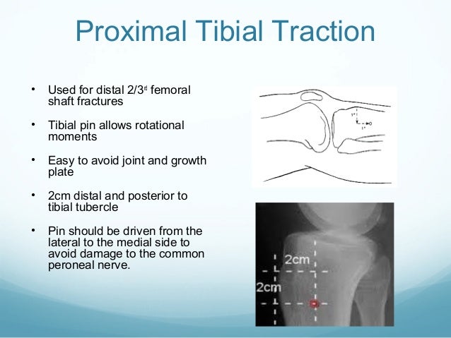Application of traction in orthopaedics