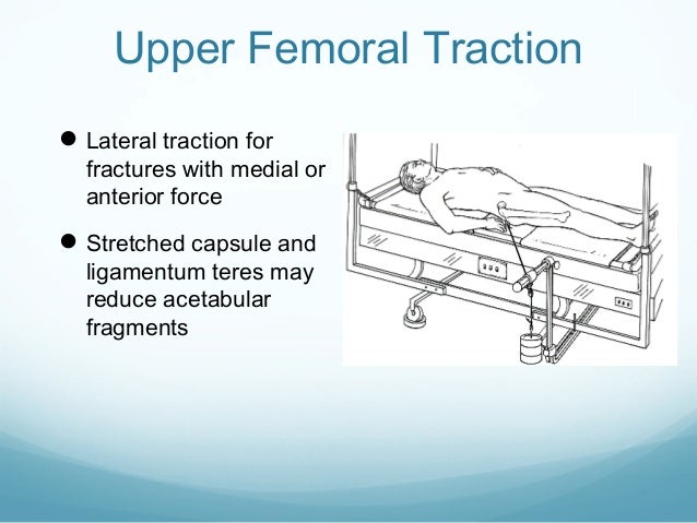 Application of traction in orthopaedics