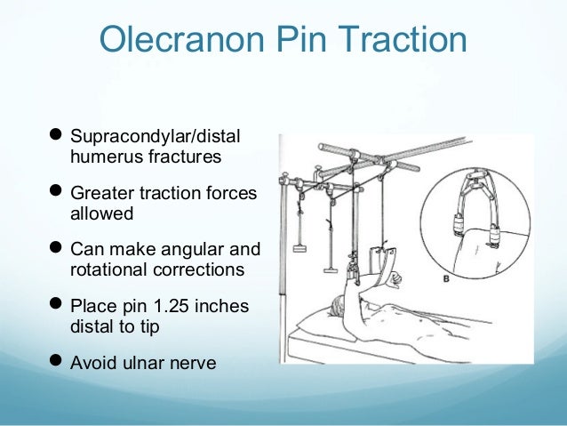 Application of traction in orthopaedics