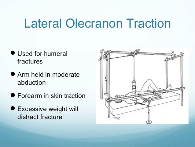 Application of traction in orthopaedics