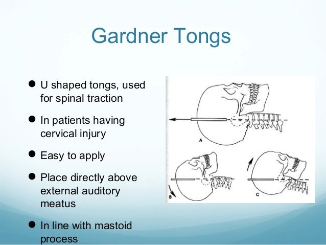 Application of traction in orthopaedics