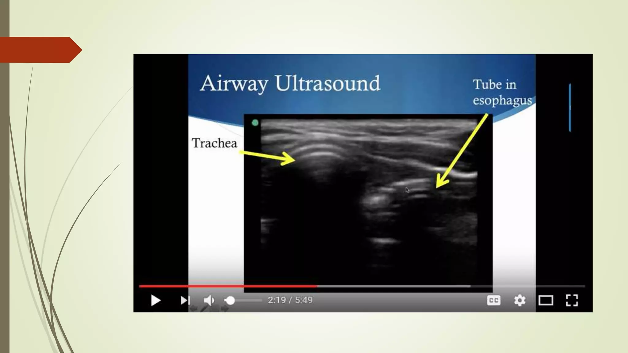 Applications of airway ultrasound in ricu | PPTX
