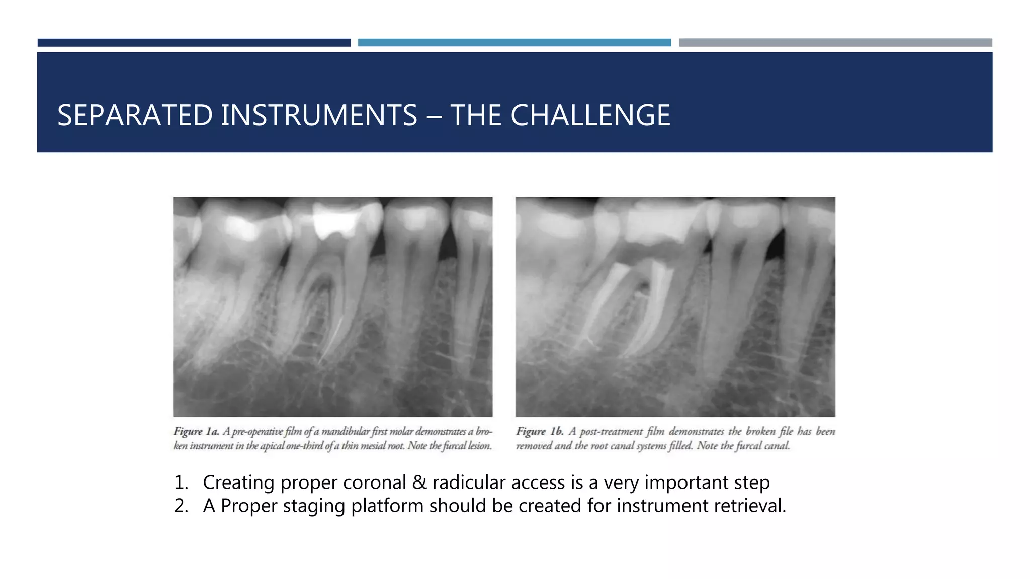 Applications of ultrasonics in endodontics | PPTX