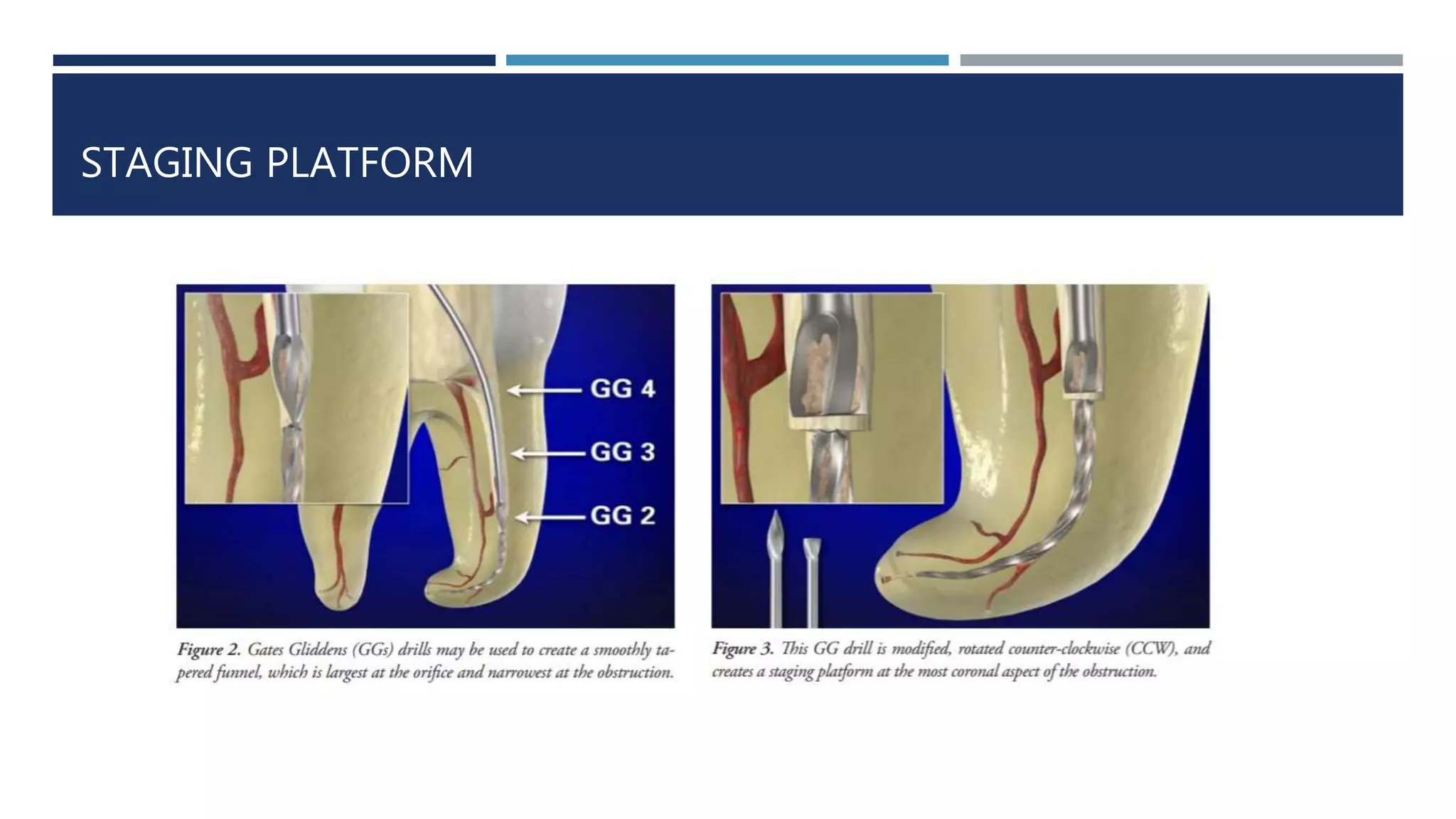 Applications of ultrasonics in endodontics | PPTX