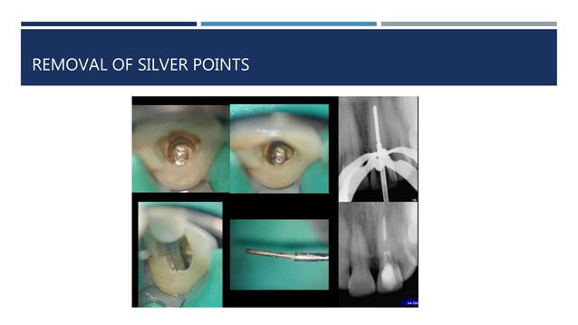 Applications of ultrasonics in endodontics | PPTX