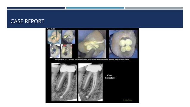Applications of ultrasonics in endodontics | PPT