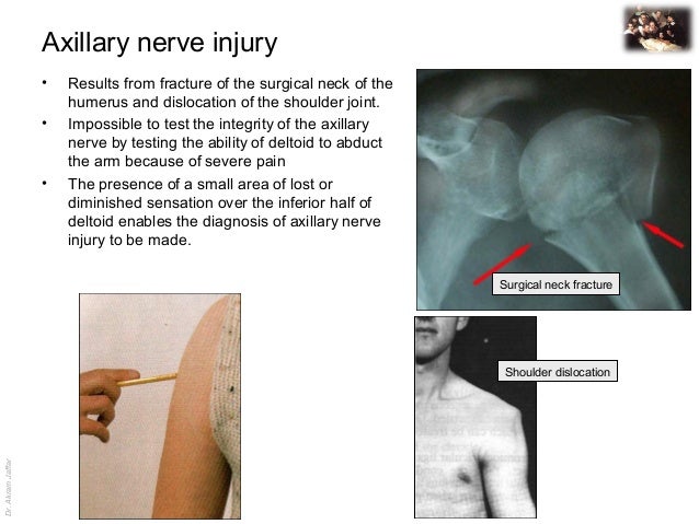 Applied anatomy axillary nerve injury