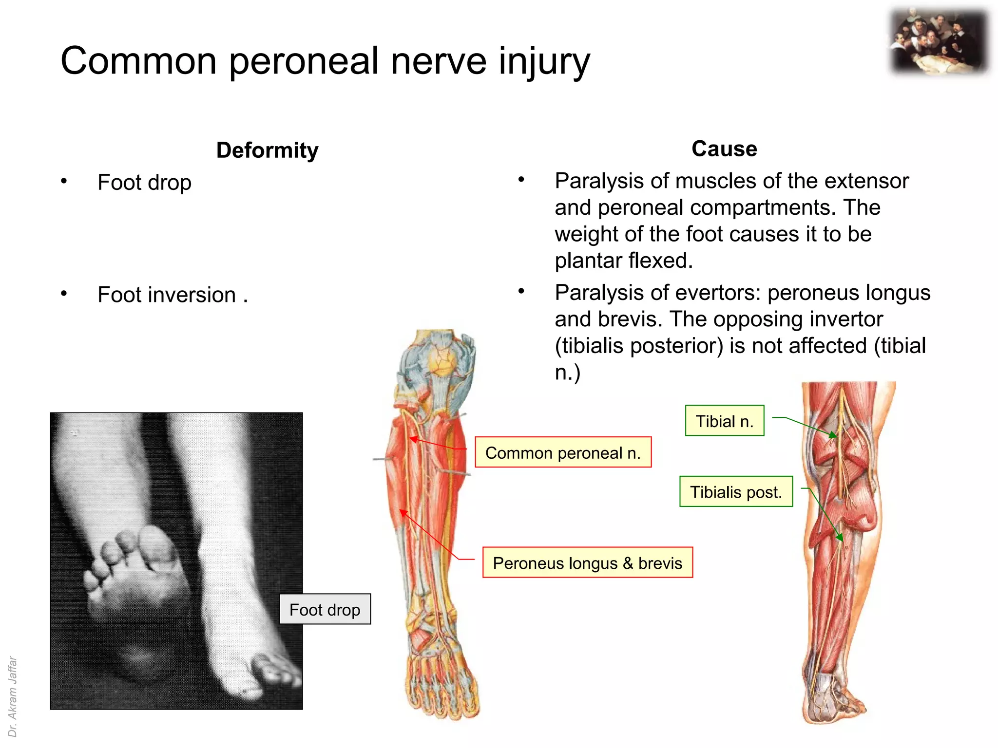 Applied anatomy common peroneal nerve injury | PPT
