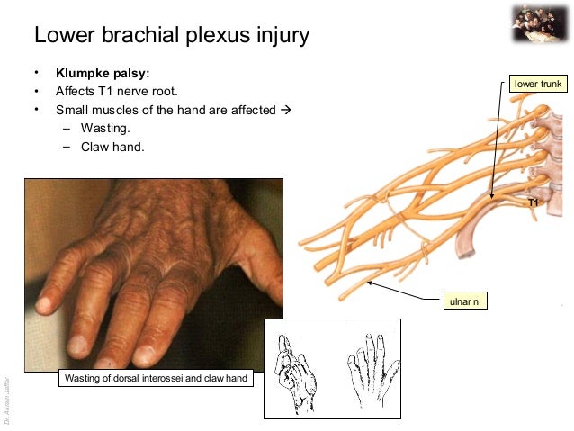 Applied anatomy lower brachial pleuxs injury