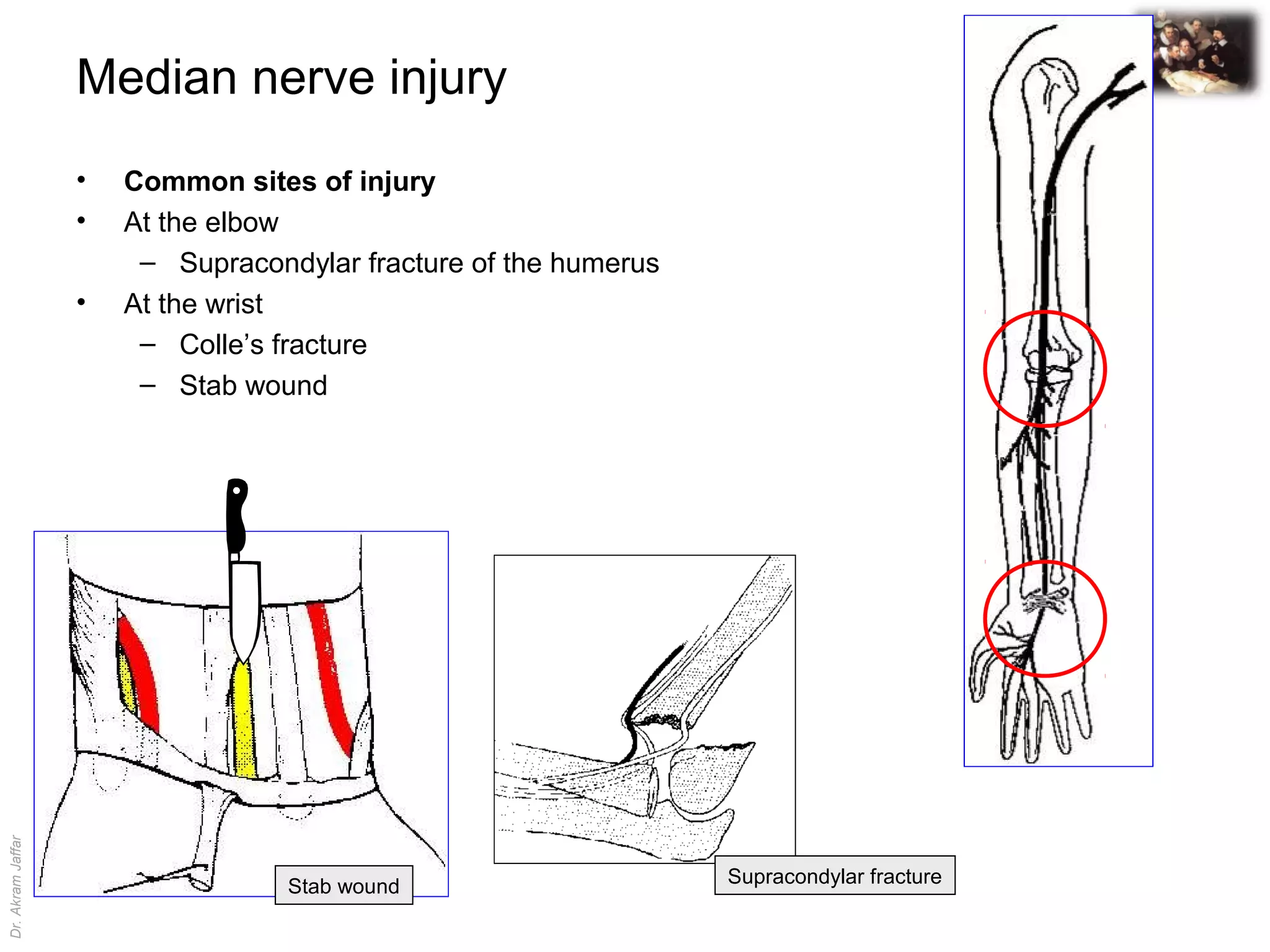 Applied anatomy median nerve injury | PPT
