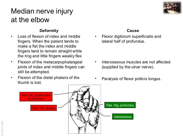 Applied anatomy median nerve injury