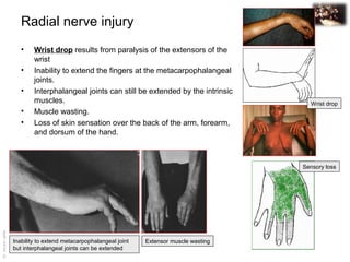 Applied anatomy radial nerve injury | PPT