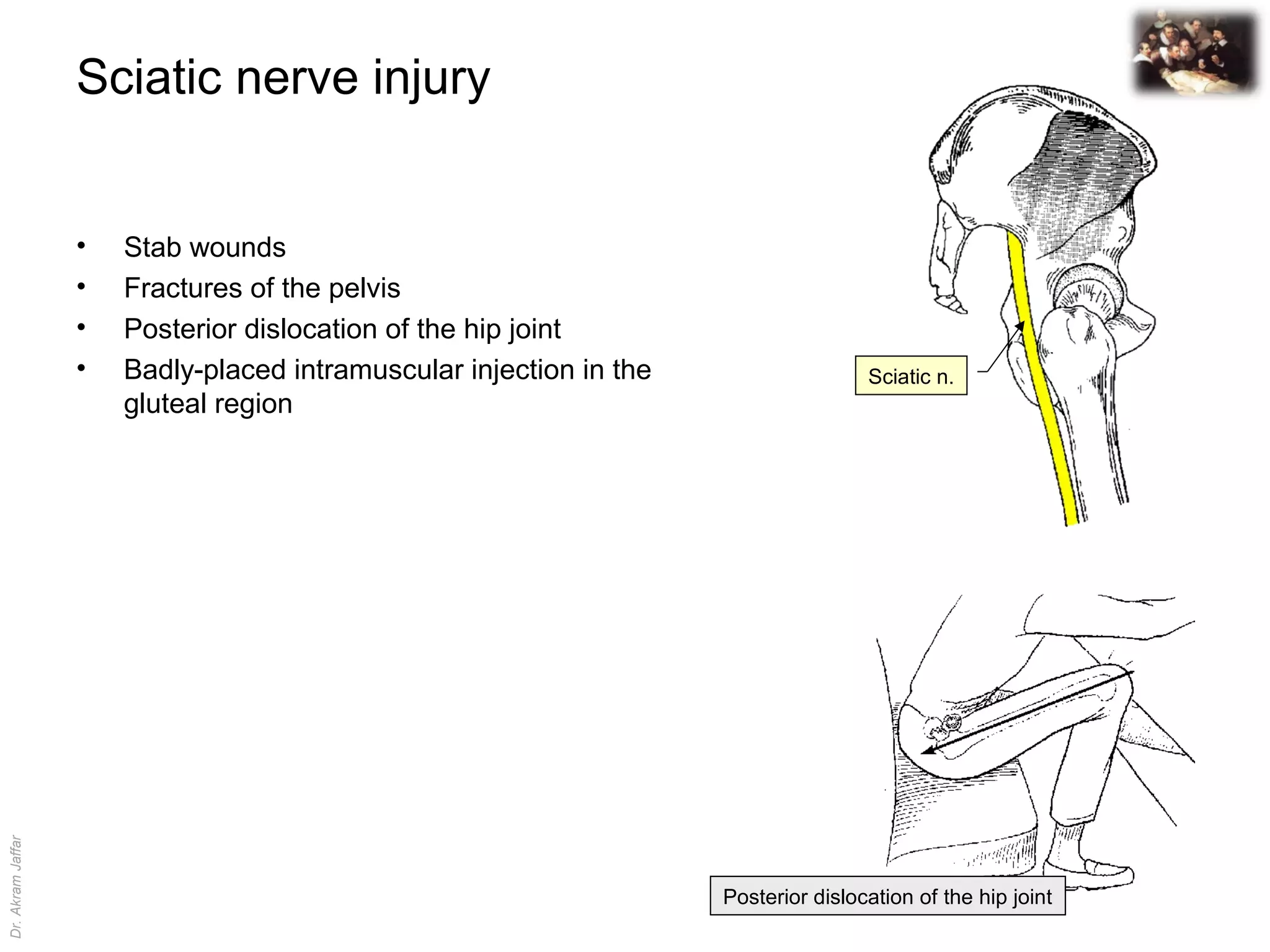Applied anatomy sciatic nerve injury | PPT