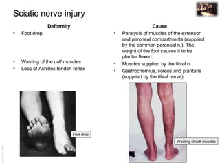 Applied anatomy sciatic nerve injury | PPT