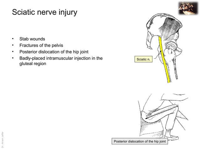 Applied anatomy sciatic nerve injury | PPT | Death, Injury, or Military ...