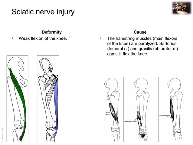 Applied anatomy sciatic nerve injury | PPT | Death, Injury, or Military ...