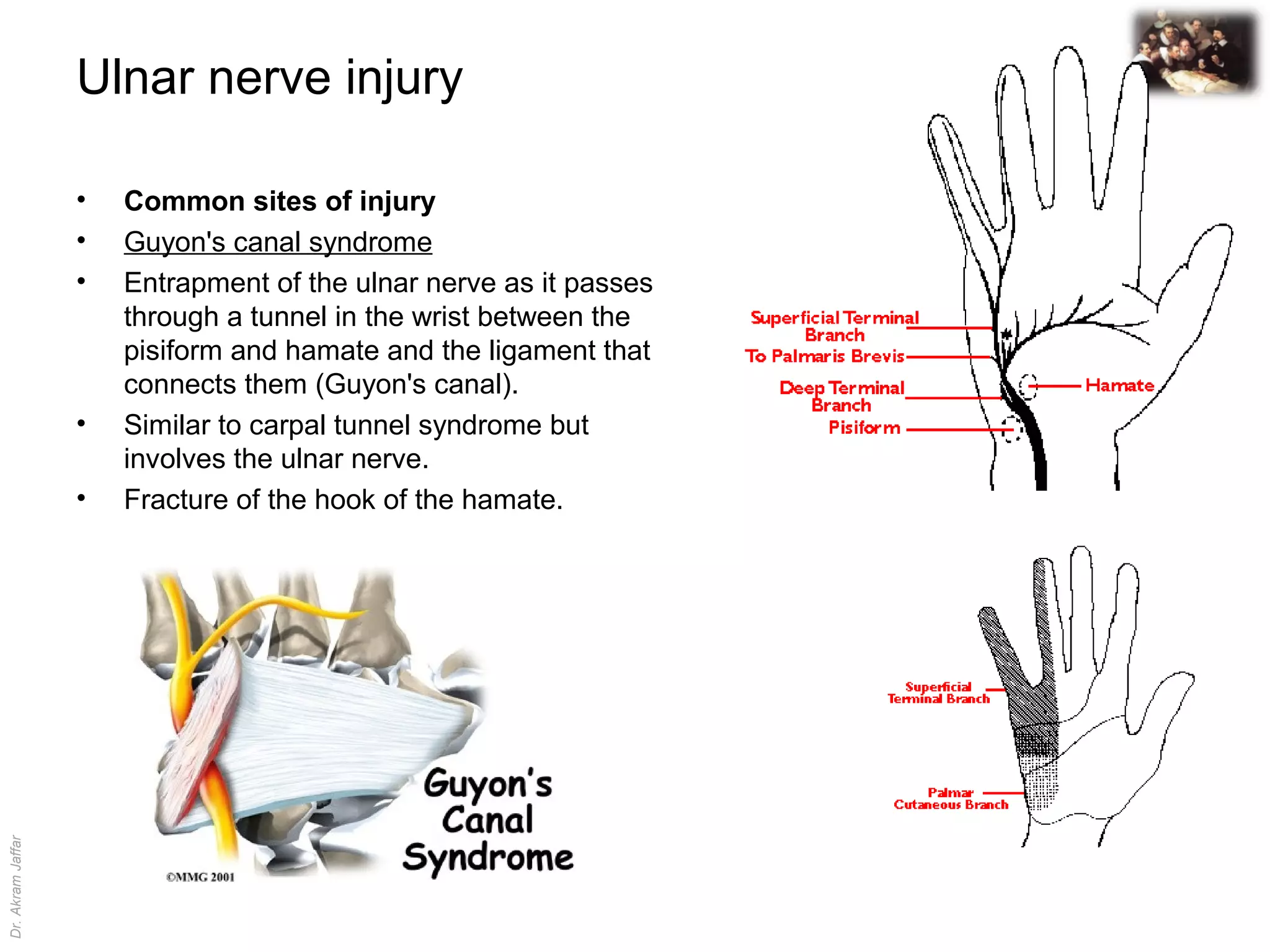 Applied anatomy ulnar nerve injury | PPT