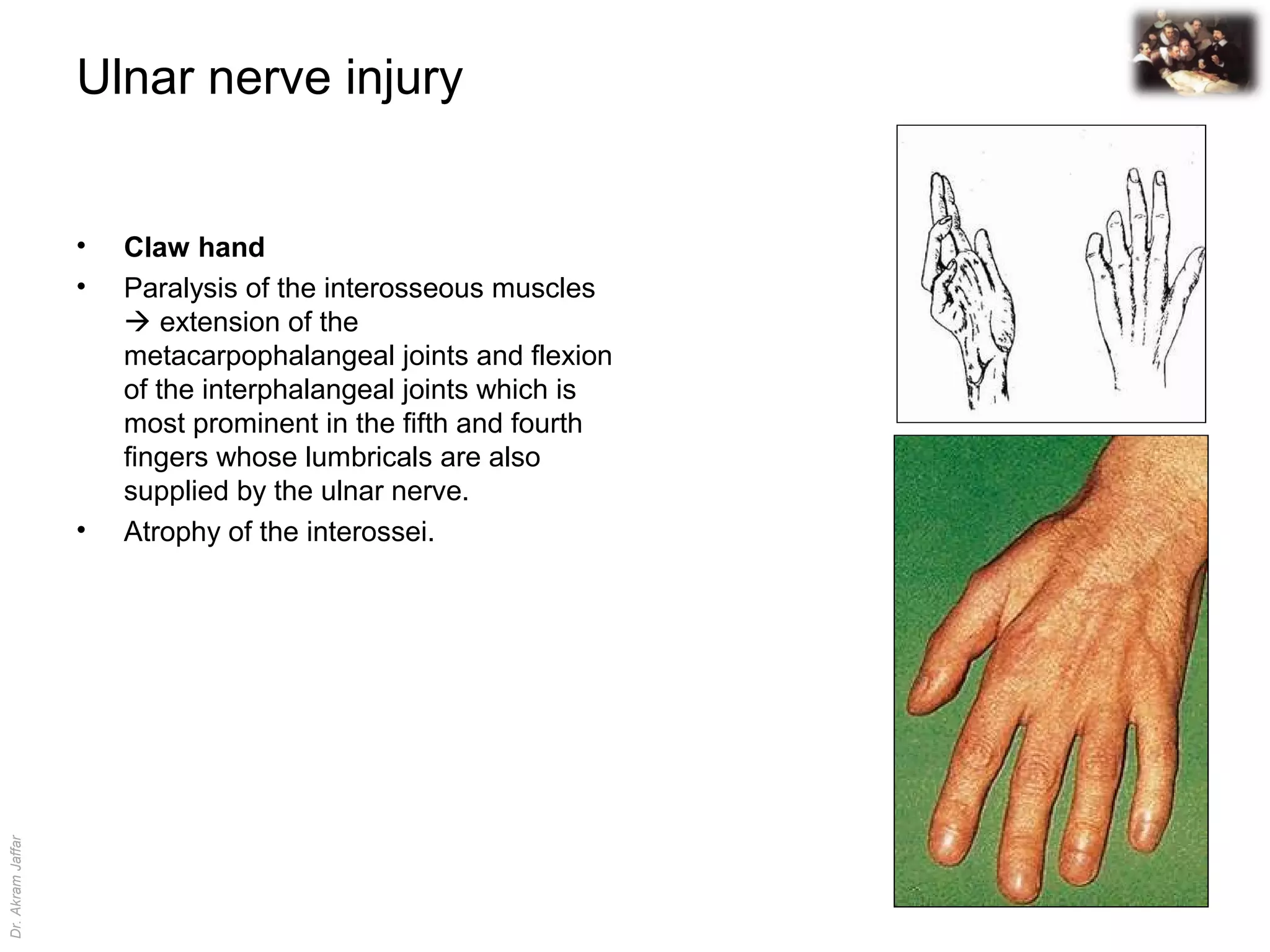Applied anatomy ulnar nerve injury | PPT