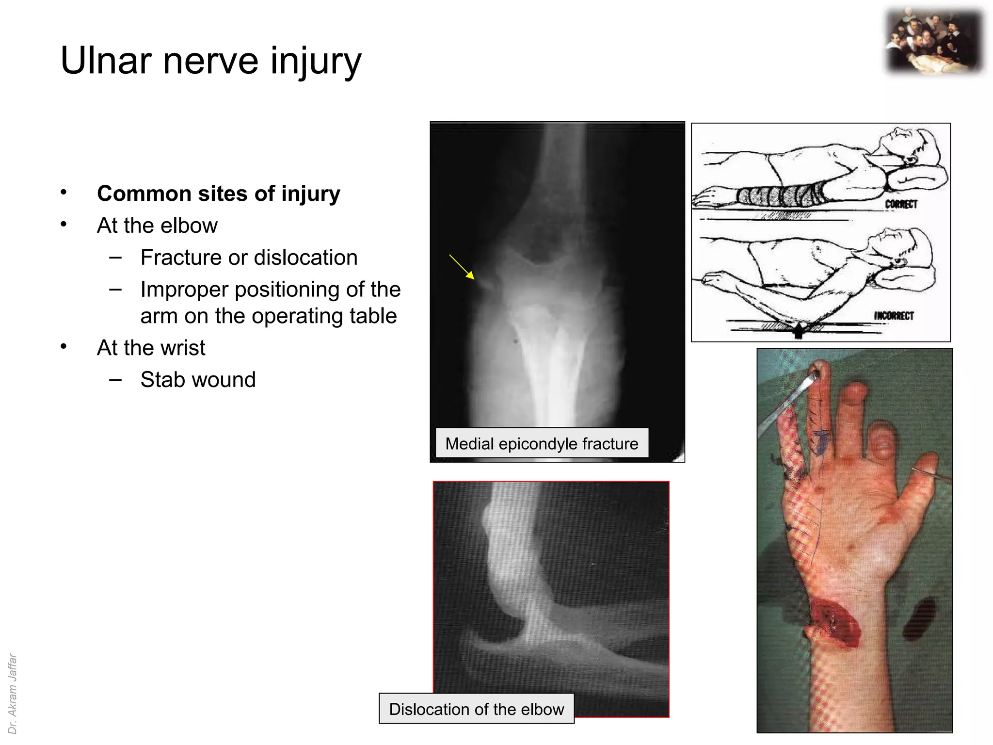 Applied anatomy ulnar nerve injury | PPT