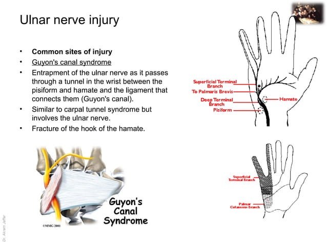 Applied anatomy ulnar nerve injury