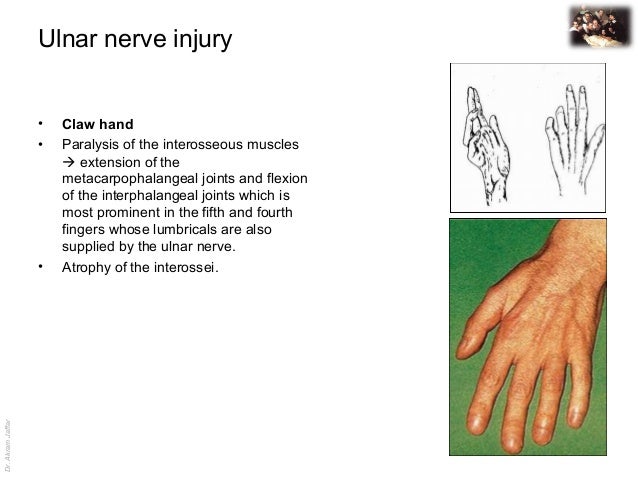 Applied anatomy ulnar nerve injury