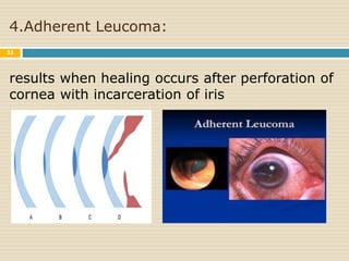 Applied anatomy and physiology of cornea | PPTX