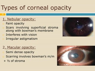 Corneal Opacity Types
