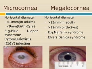 Microcornea