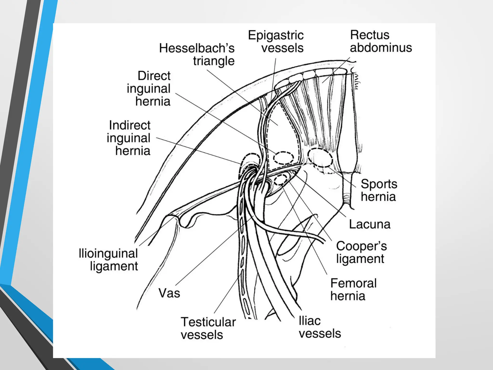 Applied anatomy of inguinal hernias.pptx