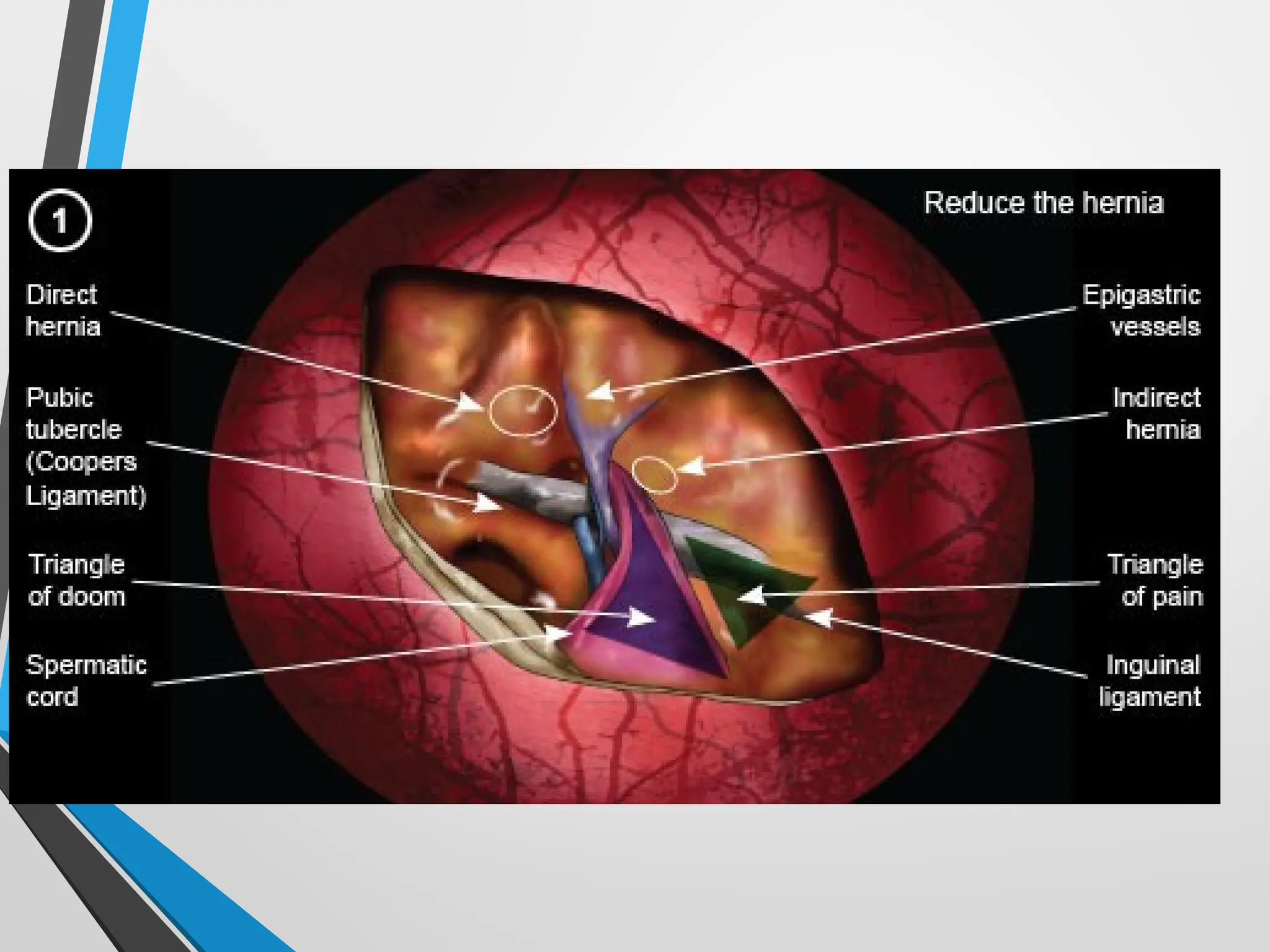 Applied anatomy of inguinal hernias.pptx
