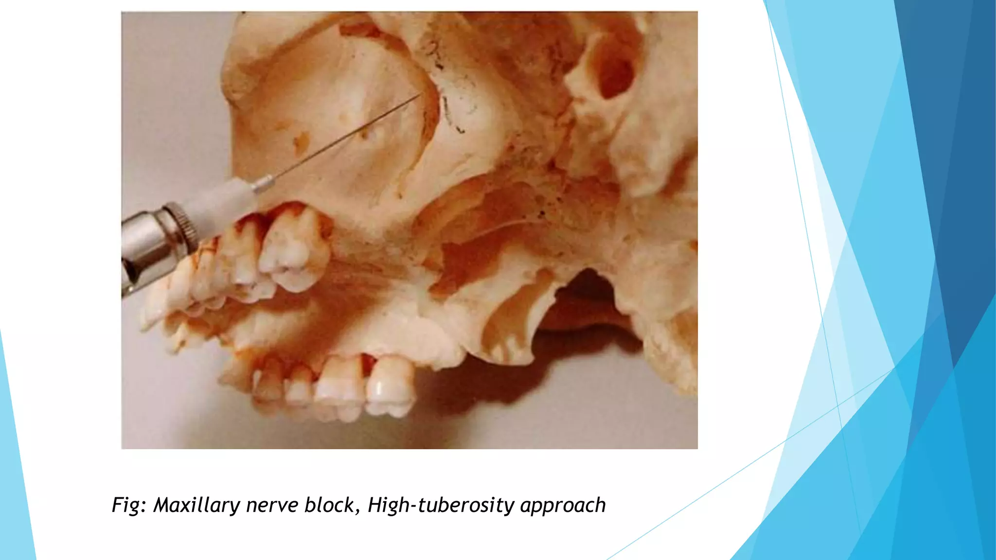 Applied anatomy of maxillary nerve | PPTX