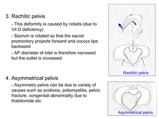Rachitic Pelvis