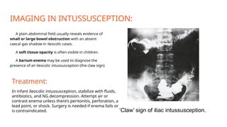 Applied Anatomy of Right Iliac Fossa, Small Bowel and Large Bowel..pptx