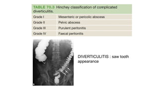 Applied Anatomy of Right Iliac Fossa, Small Bowel and Large Bowel..pptx