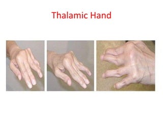 Applied anatomy of thalamus | PPT