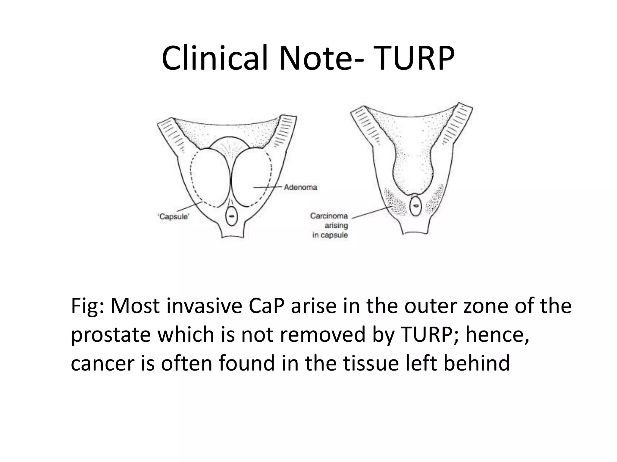 Applied anatomy of the prostate and seminal vesicles | PPTX
