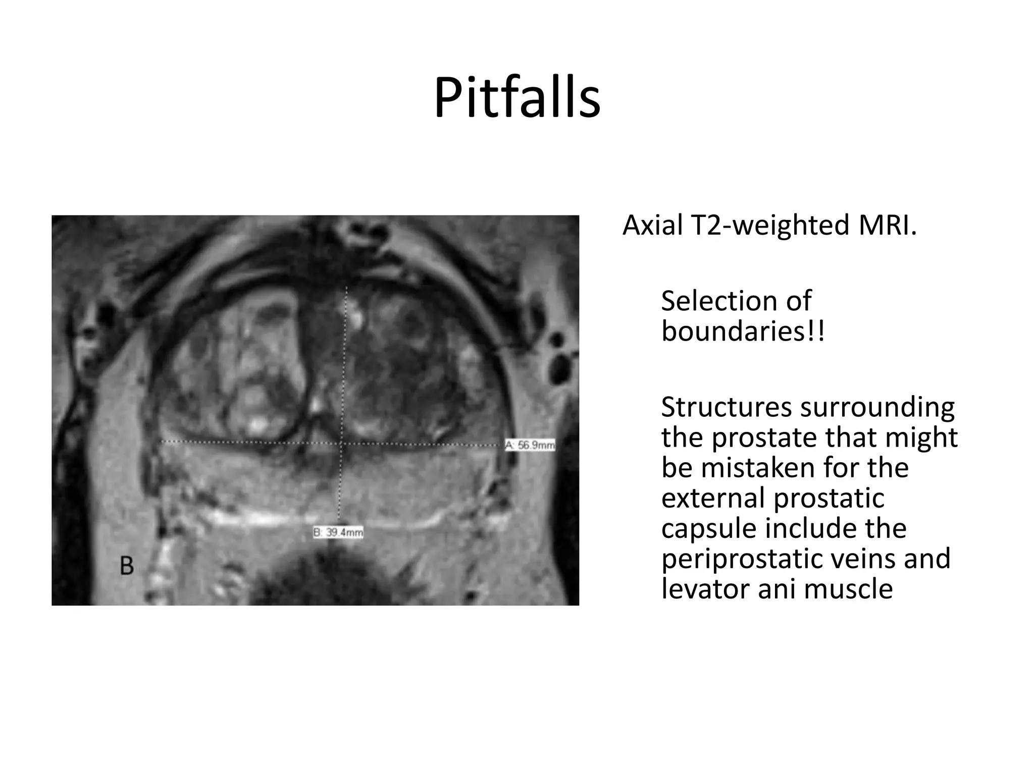 Applied anatomy of the prostate and seminal vesicles | PPTX