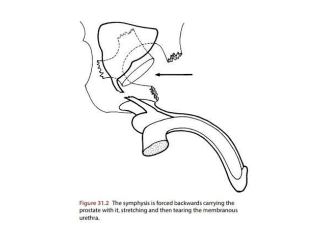 Applied anatomy of the prostate and seminal vesicles | PPTX