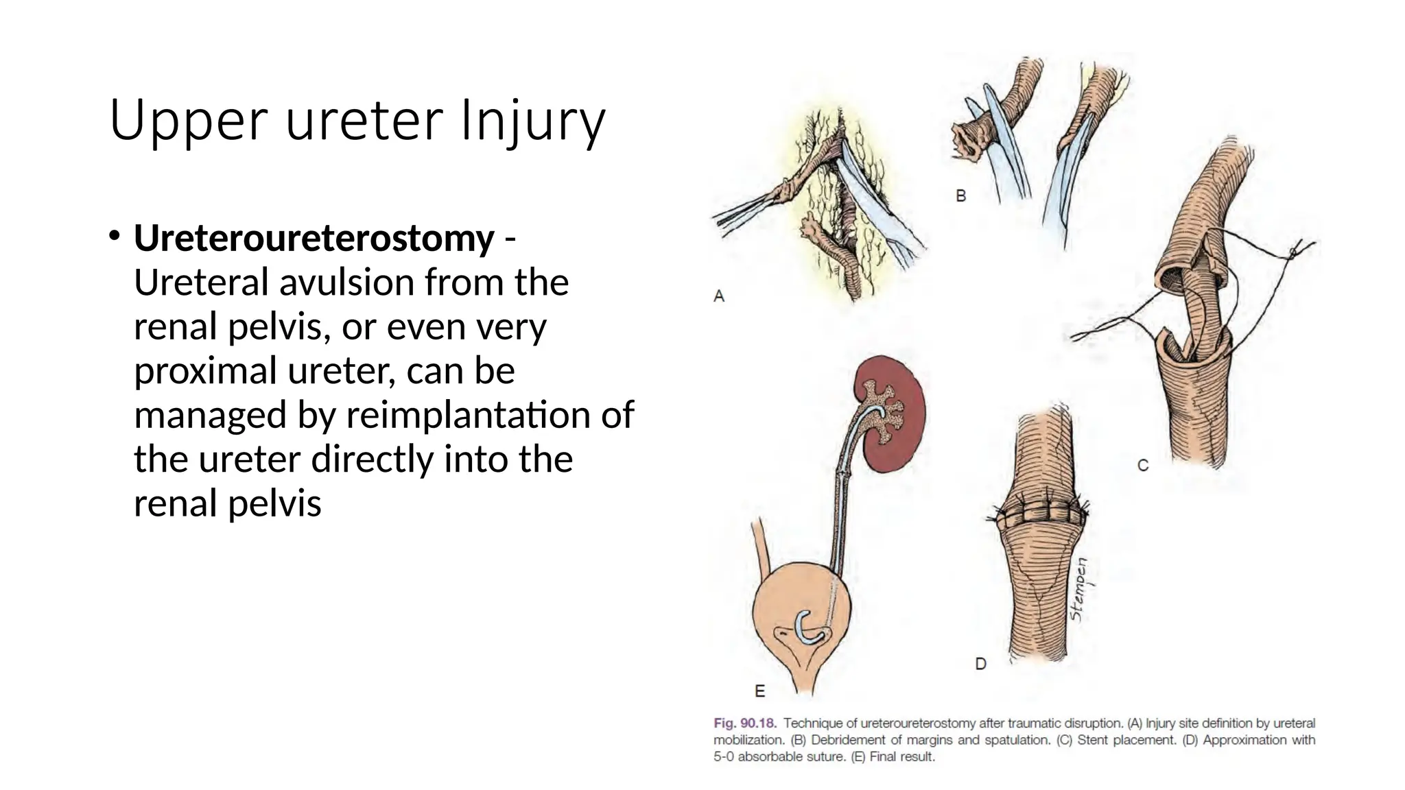 Applied Anatomy of Ureter in detail for urologist | PPTX