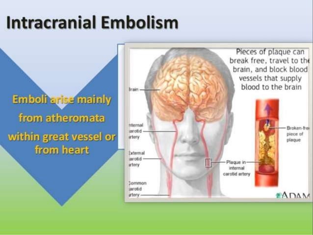 Applied aspect of internal capsule | PPTX | Brain and Nervous System ...