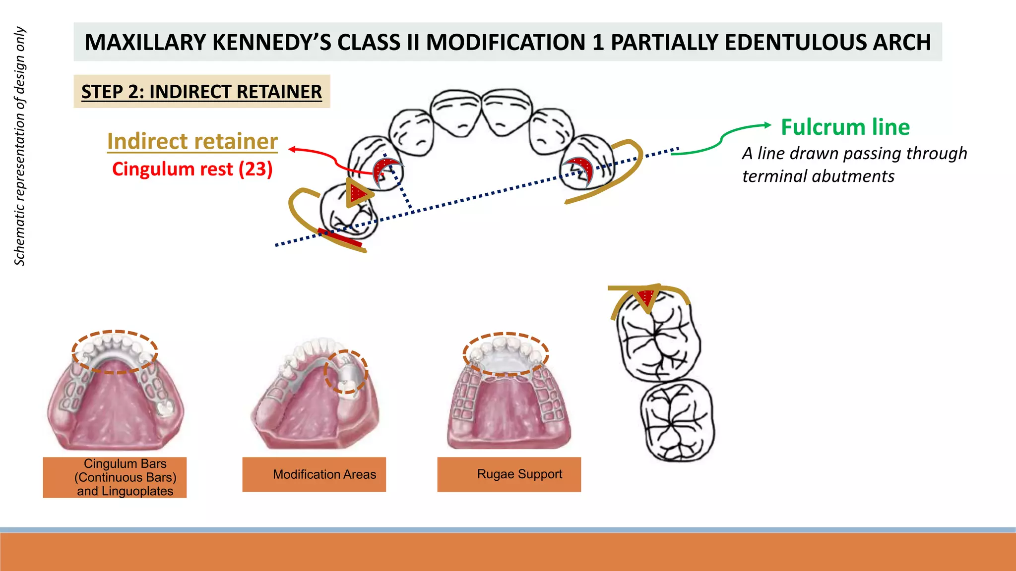 APPLIED ASPECTS OF CAST PARTIAL DENTURE DESIGNING.pptx