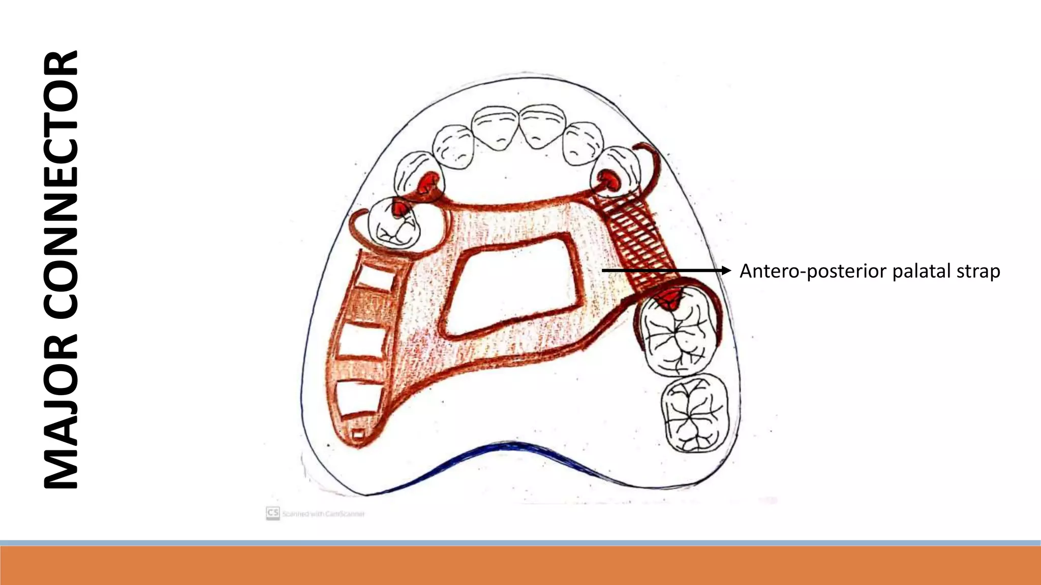 APPLIED ASPECTS OF CAST PARTIAL DENTURE DESIGNING.pptx