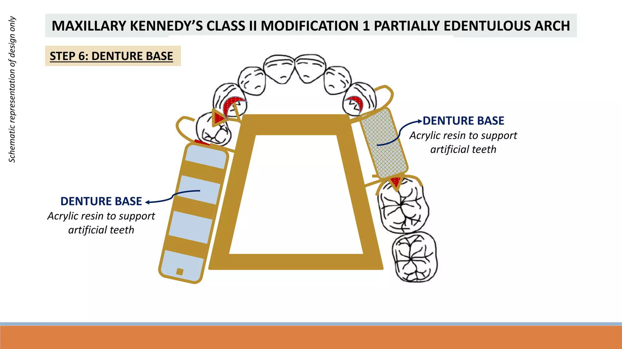 APPLIED ASPECTS OF CAST PARTIAL DENTURE DESIGNING.pptx