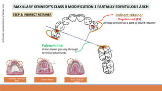 APPLIED ASPECTS OF CAST PARTIAL DENTURE DESIGNING.pptx